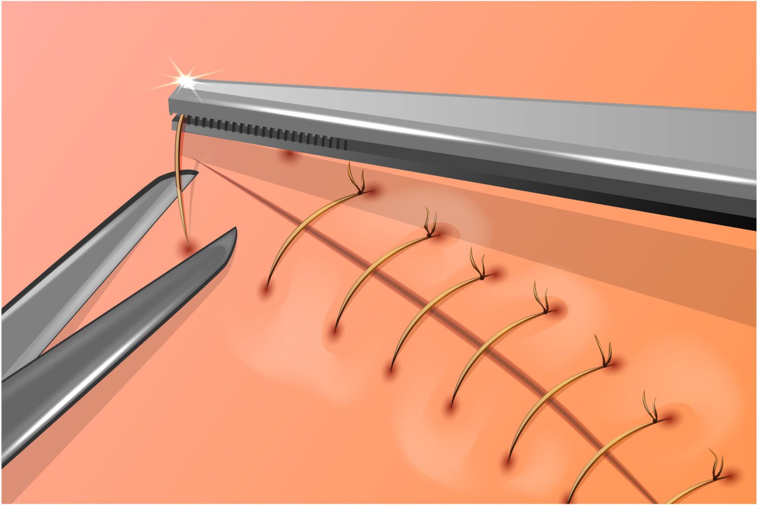 Suture Removal - Evergreen Surgical Pilonidal Clinic